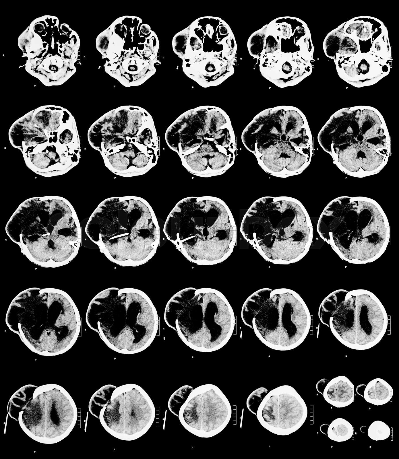 Brain CT Scan | Stock image | Colourbox