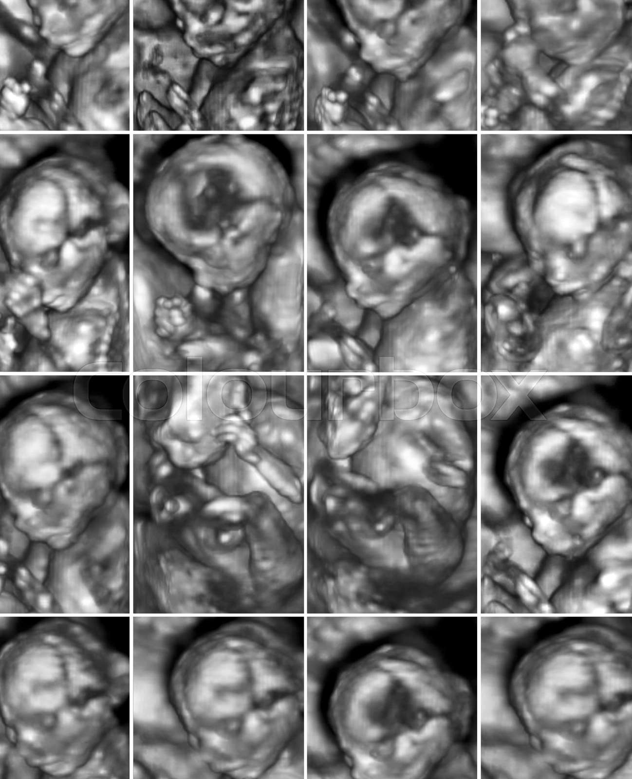 Collage of 16 medical images of 3D ultrasound anomaly scan on a female ...