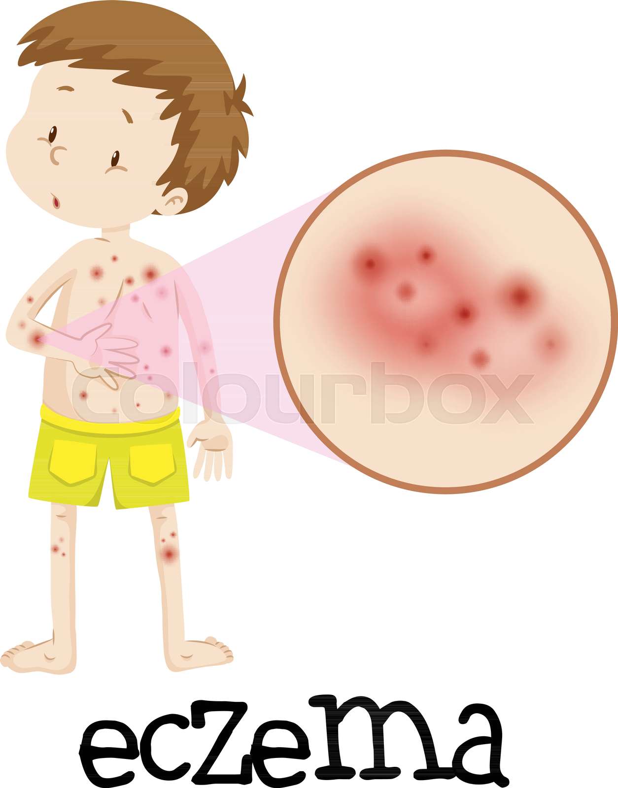 Human Medical Education of Eczema | Stock vector | Colourbox