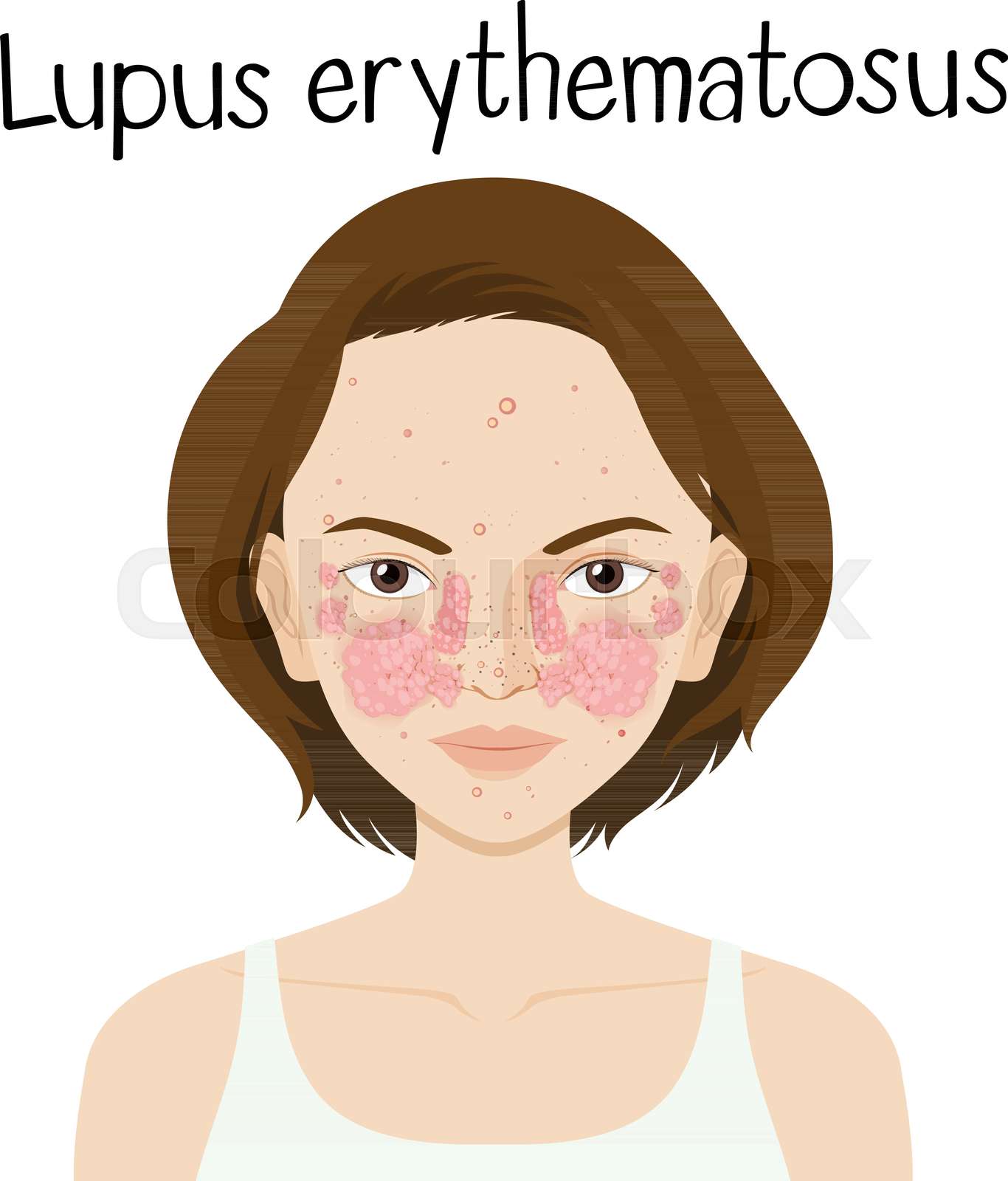 A Vector of Lupus Erythematosus | Stock vector | Colourbox