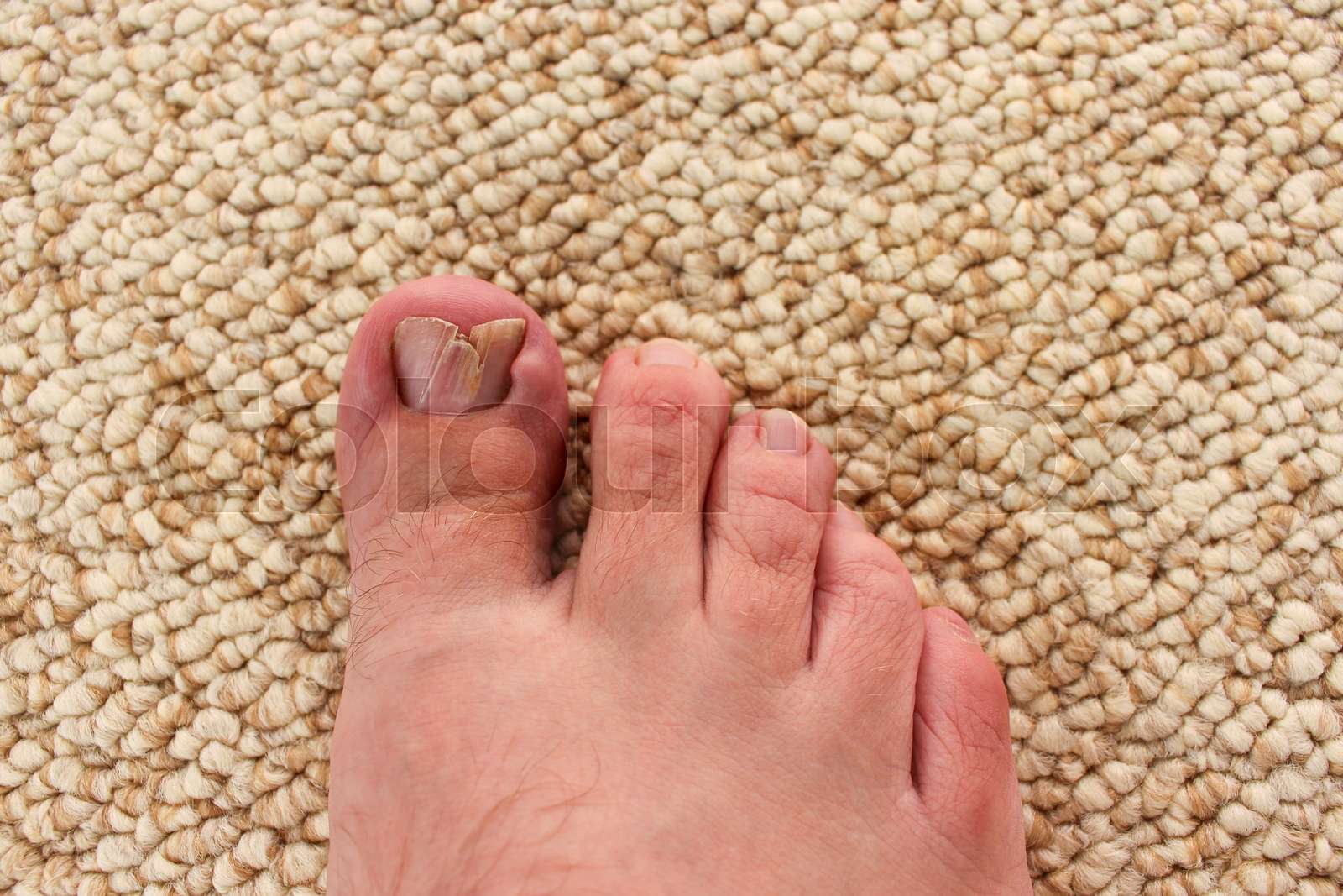 Damaged toenail | Stock image | Colourbox