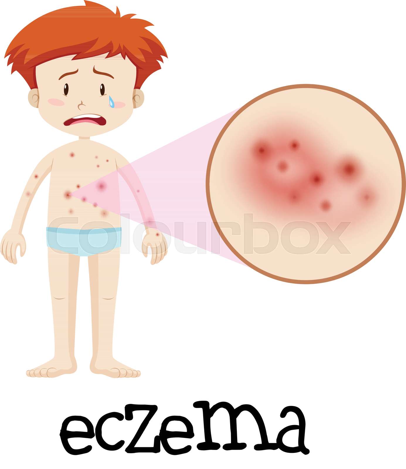 A Boy Having Eczema on Body Skin | Stock vector | Colourbox