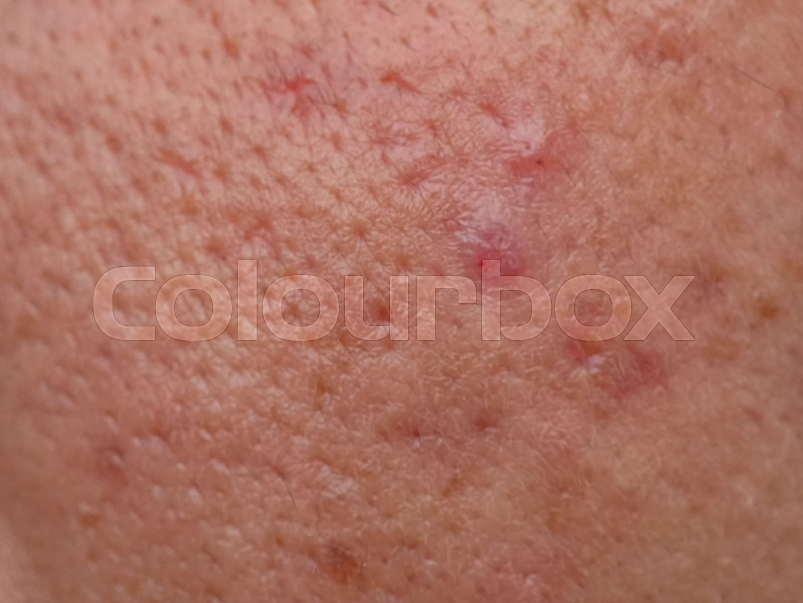 closeup skin problems, nodular cystic acne skin | Stock image | Colourbox