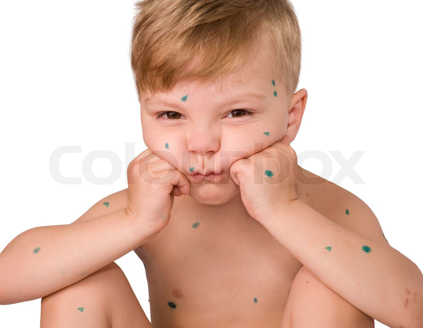 Portrait of young boy suffering from Chickenpox | Stock image | Colourbox