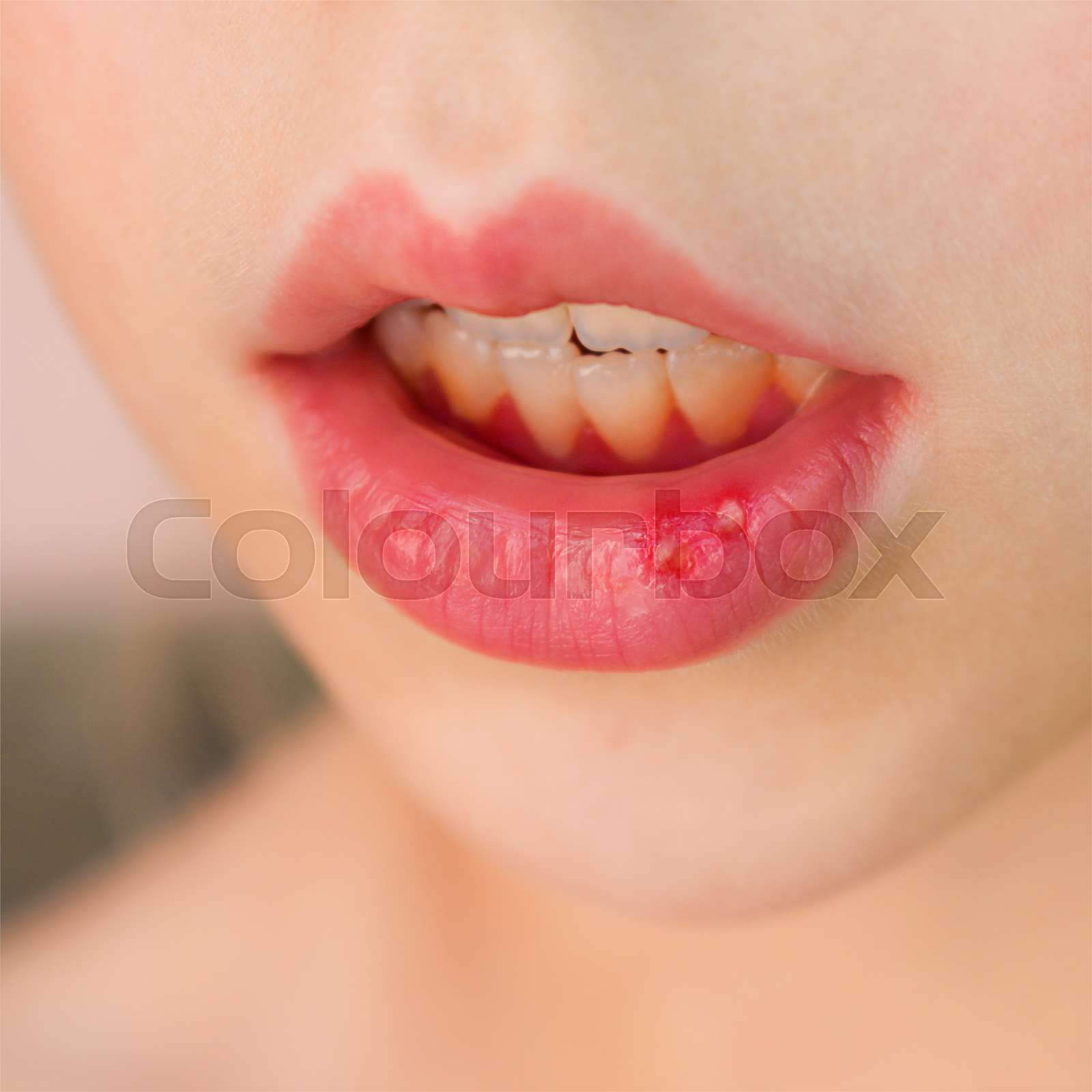 Stomatitis on the lip in child | Stock image | Colourbox