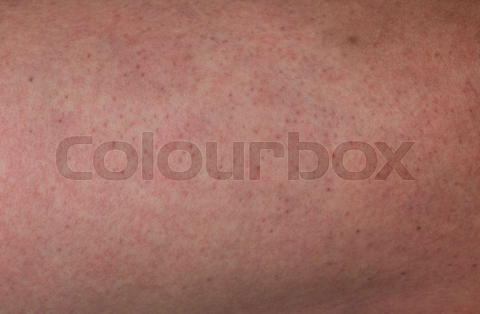 Close up human skin with red rashes from dengue disease | Stock image ...