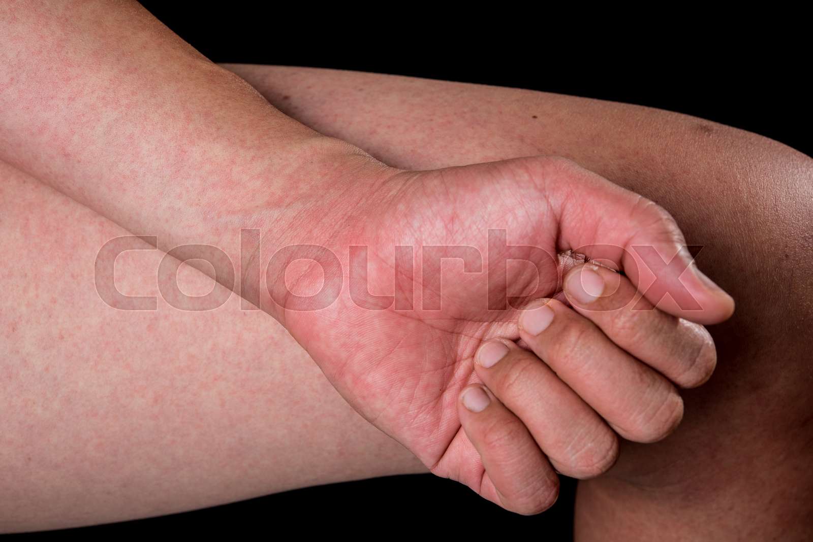 Close up human skin with red rashes from dengue disease | Stock image ...