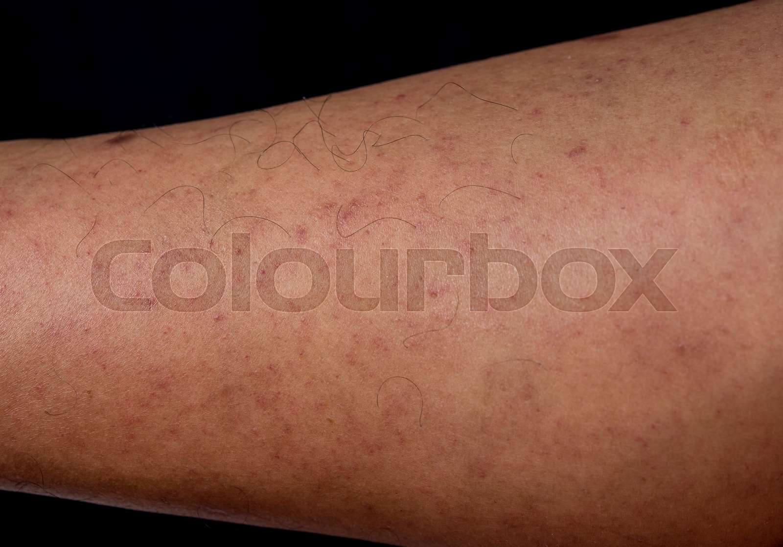 Close up human skin with red rashes from dengue disease | Stock image ...