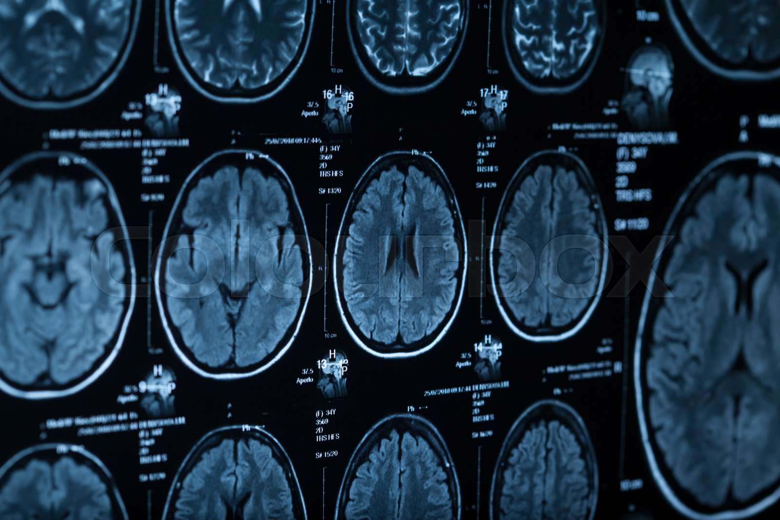 The X-ray of the human brain | Stock image | Colourbox