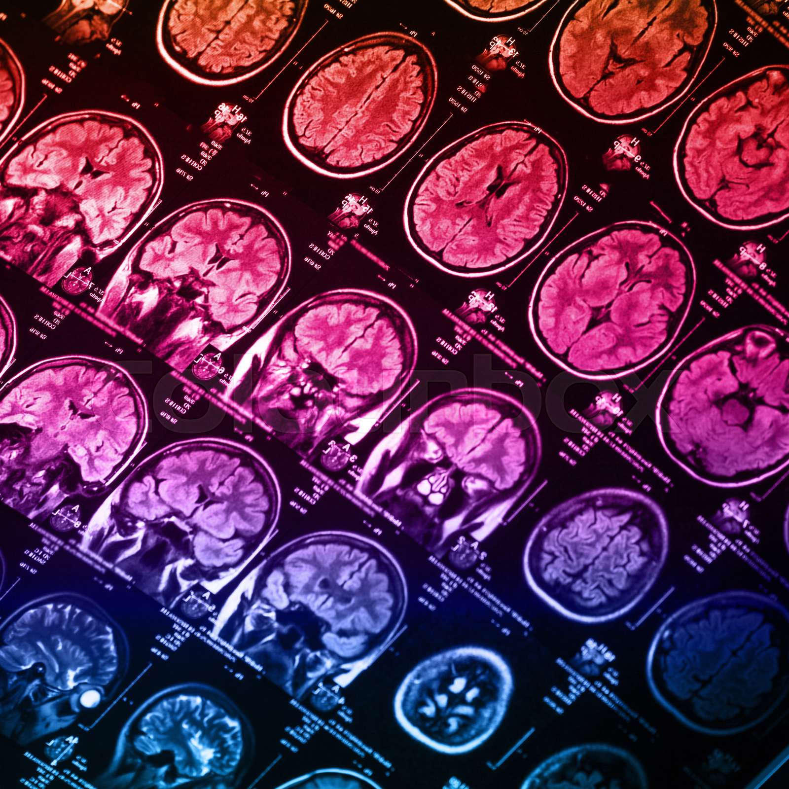 The X-ray of the human brain | Stock image | Colourbox