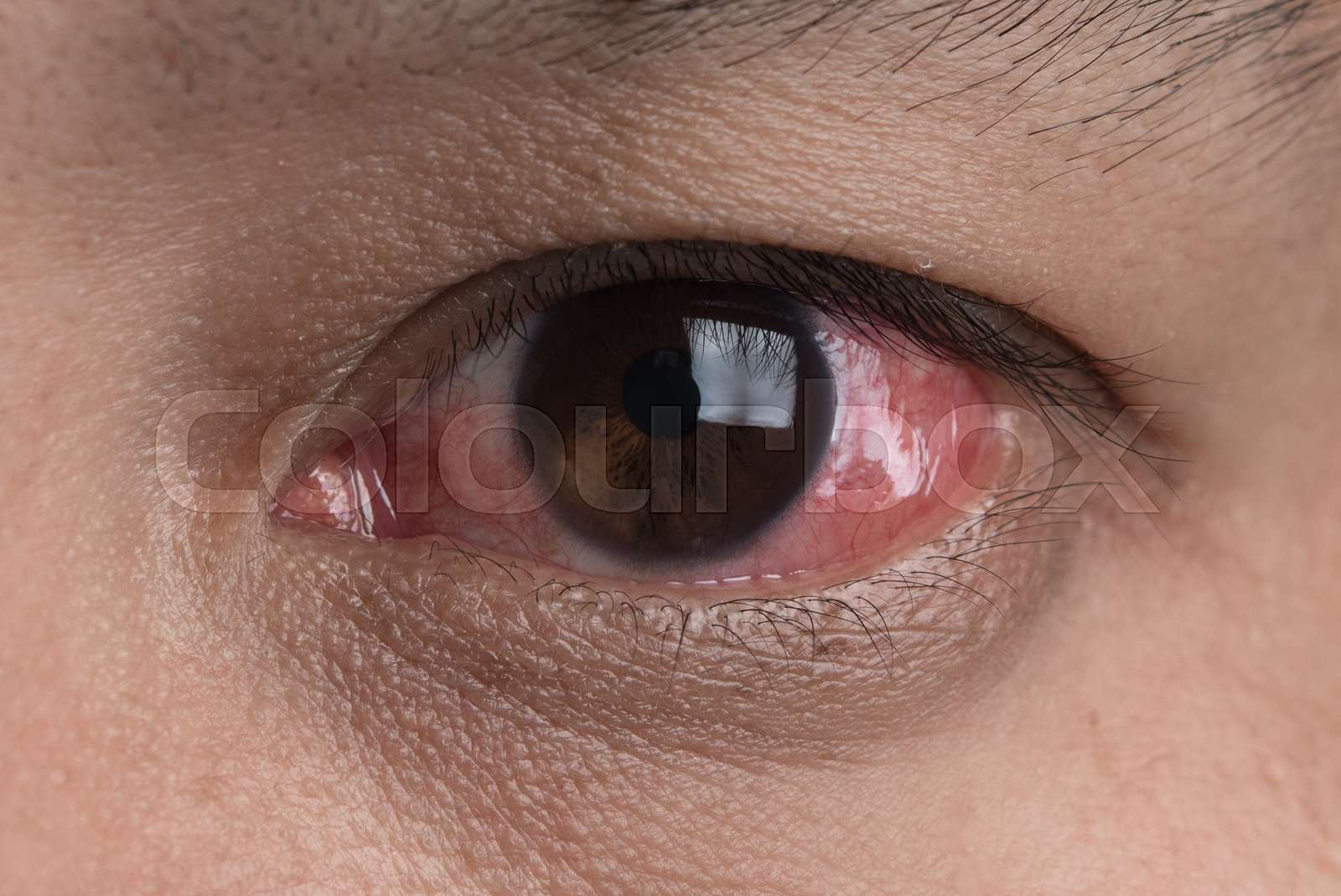 Human's red eye conjunctivitis | Stock image | Colourbox