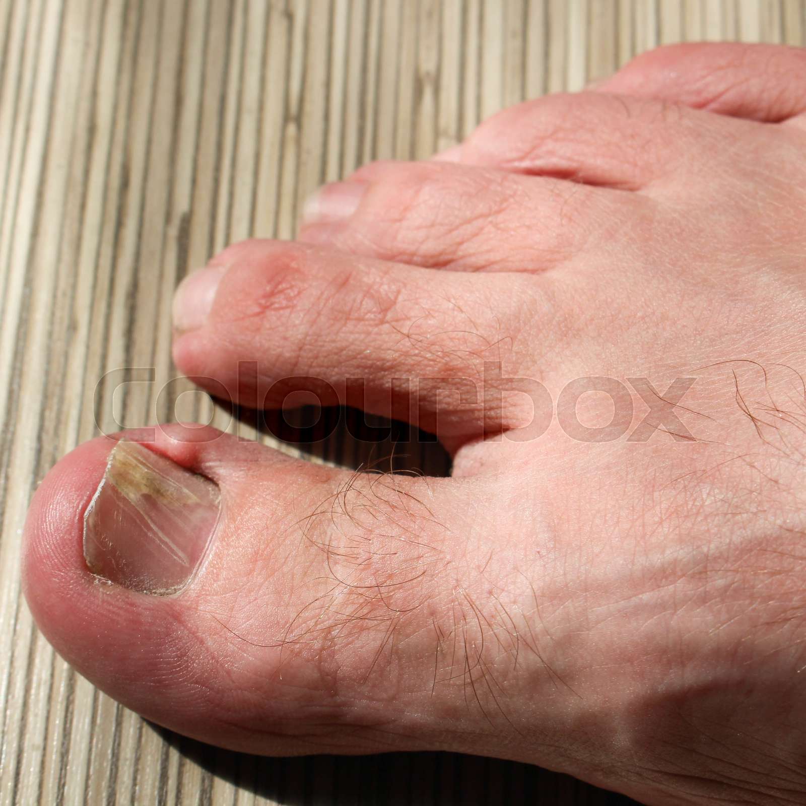 Damaged toenail | Stock image | Colourbox