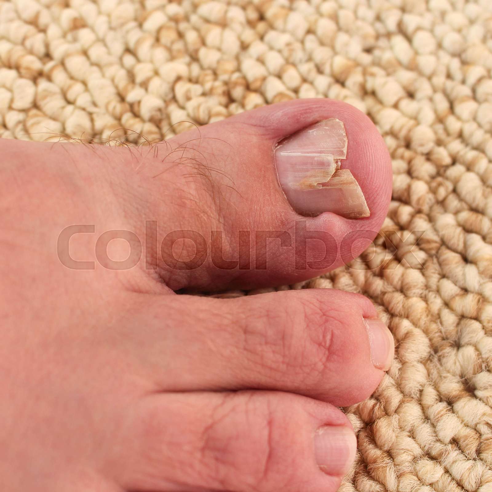 Damaged toenail | Stock image | Colourbox