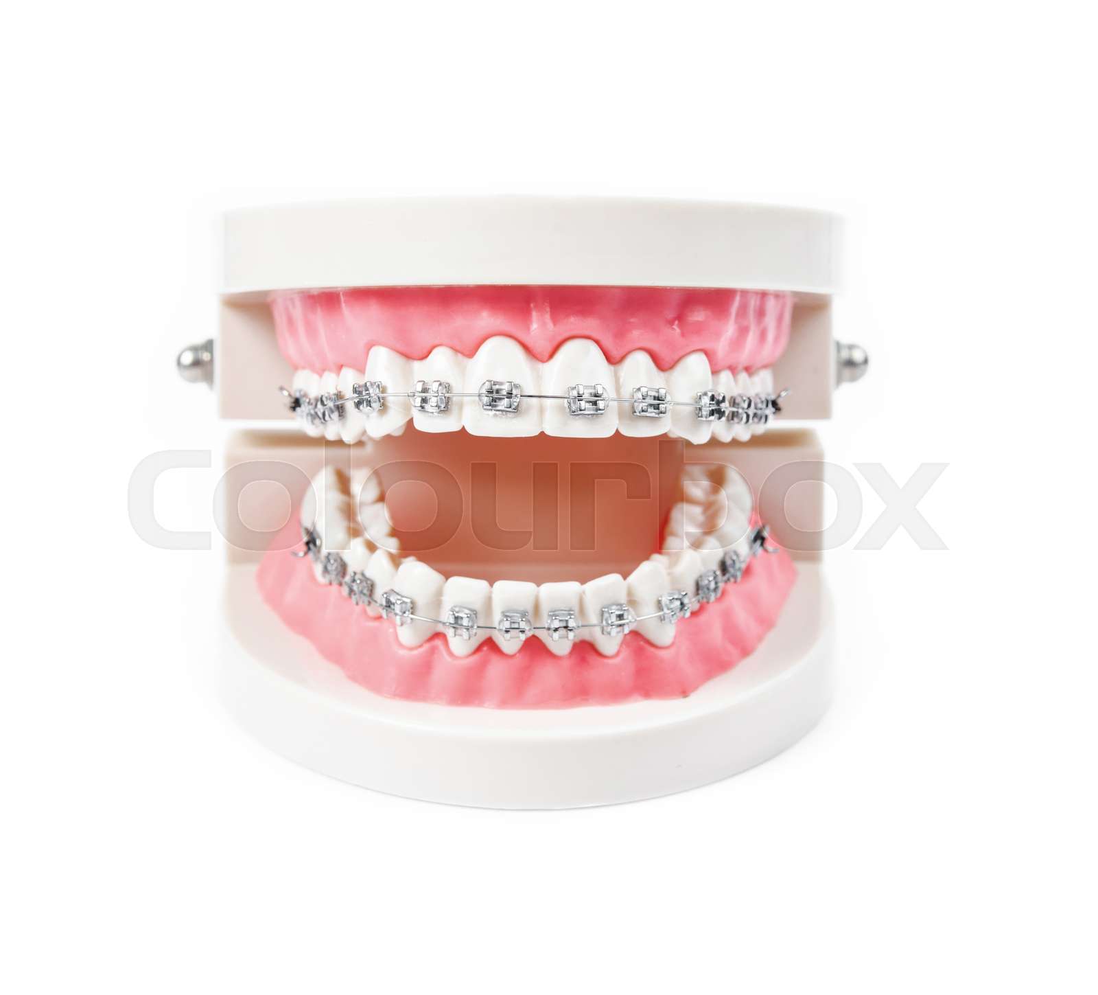 tooth model with metal wire dental braces. | Stock image | Colourbox