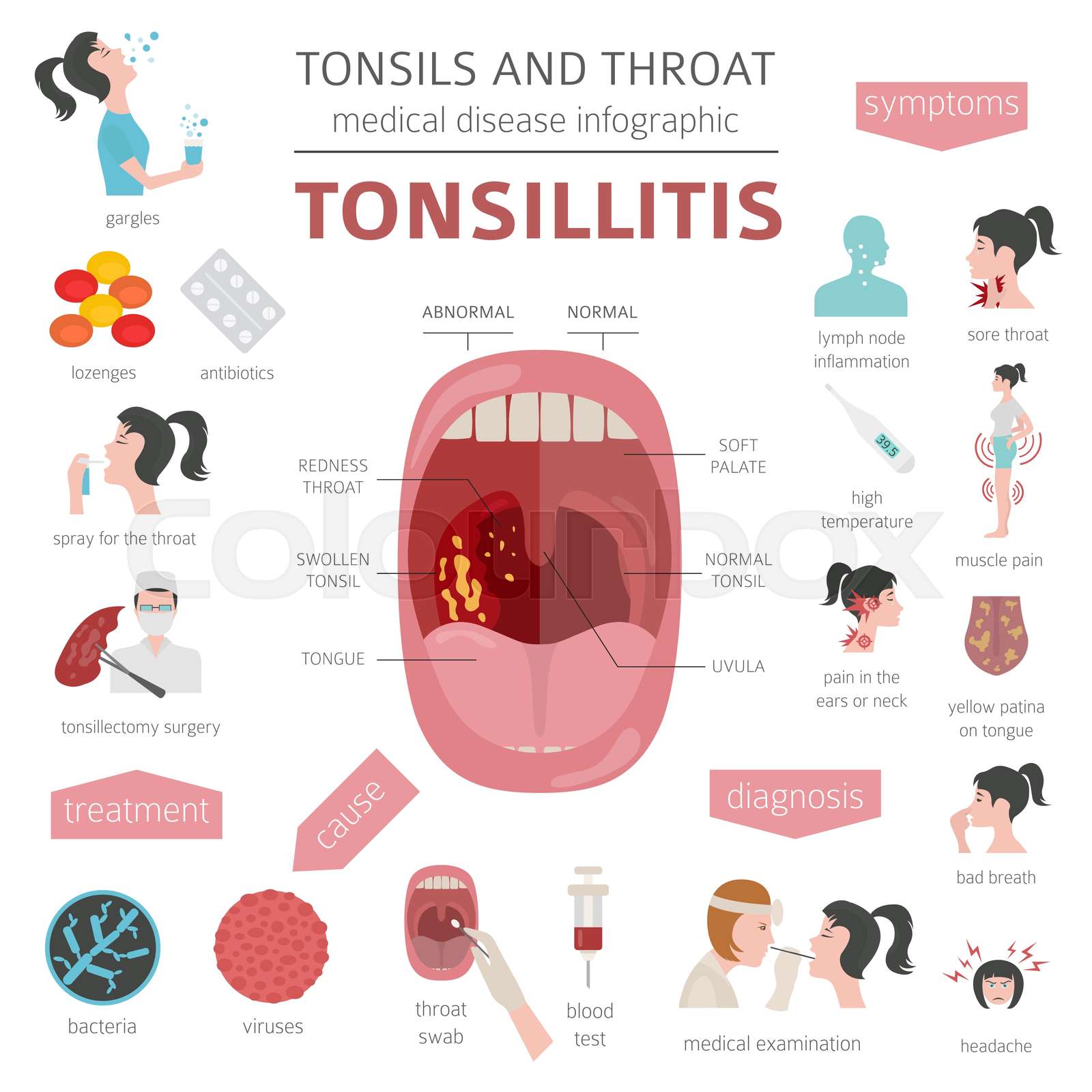 Tonsils and throat diseases. Tonsillitis symptoms, treatment icon set ...