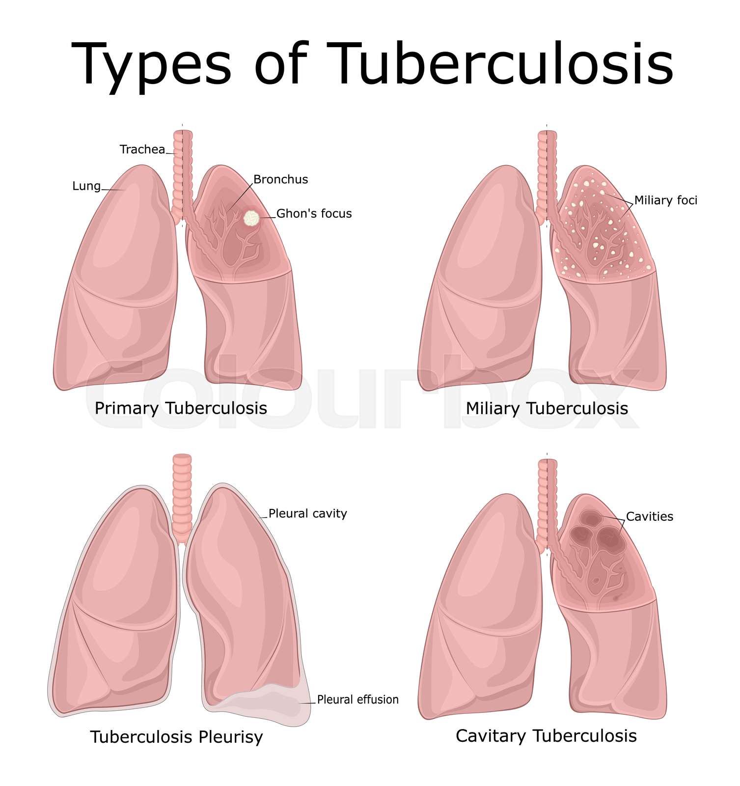 Types of Tuberculosis | Stock vector | Colourbox