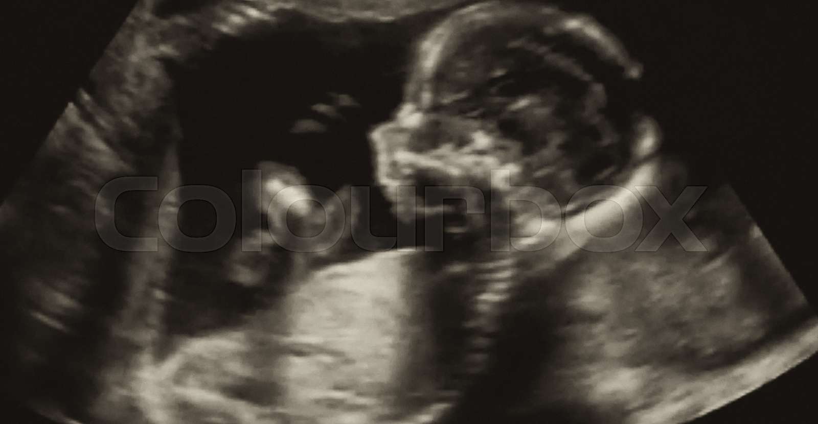 Obstetric Ultrasonography Ultrasound Echography of a first months fetus ...