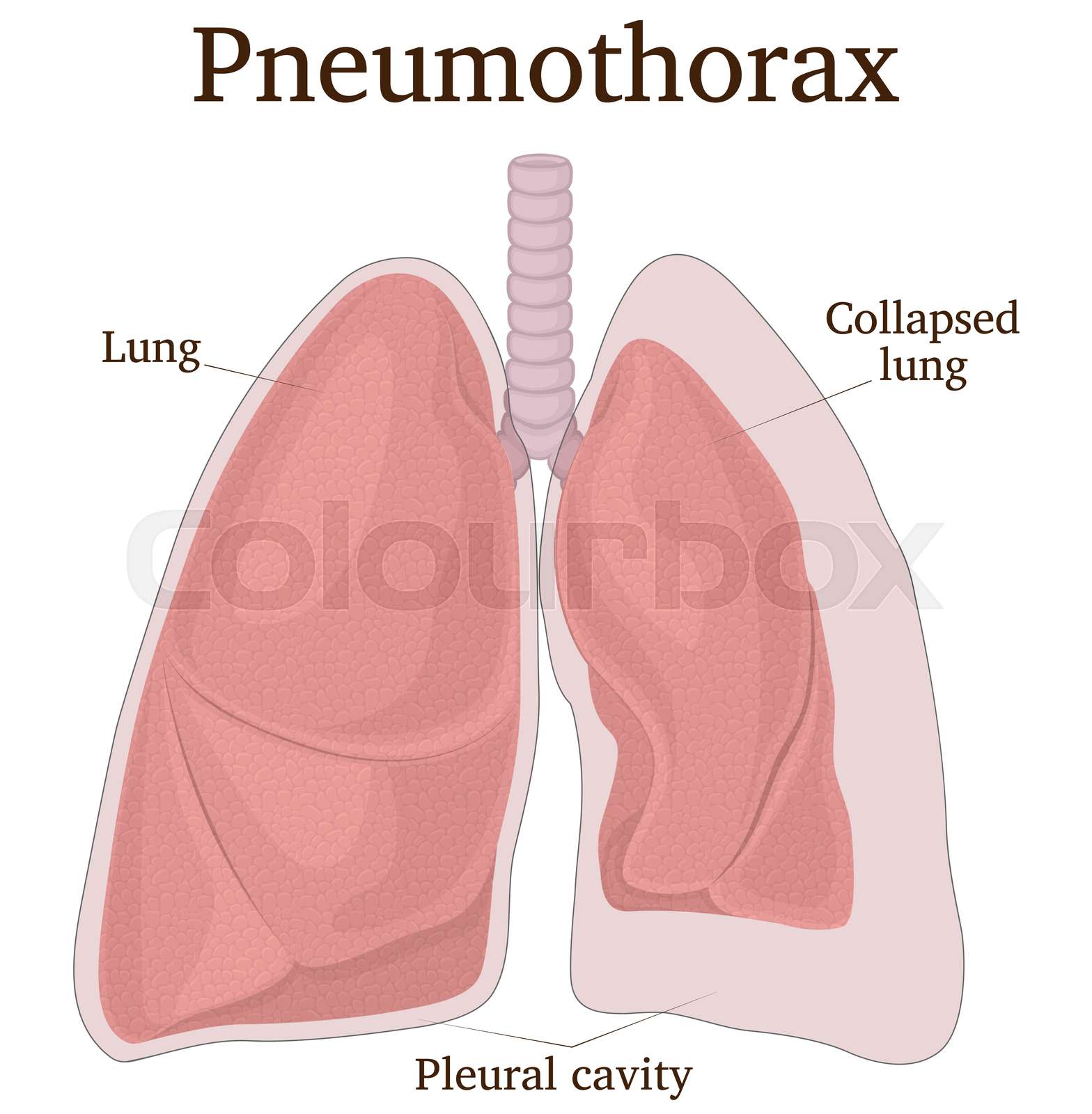 Illustration of Pneumothorax | Stock vector | Colourbox