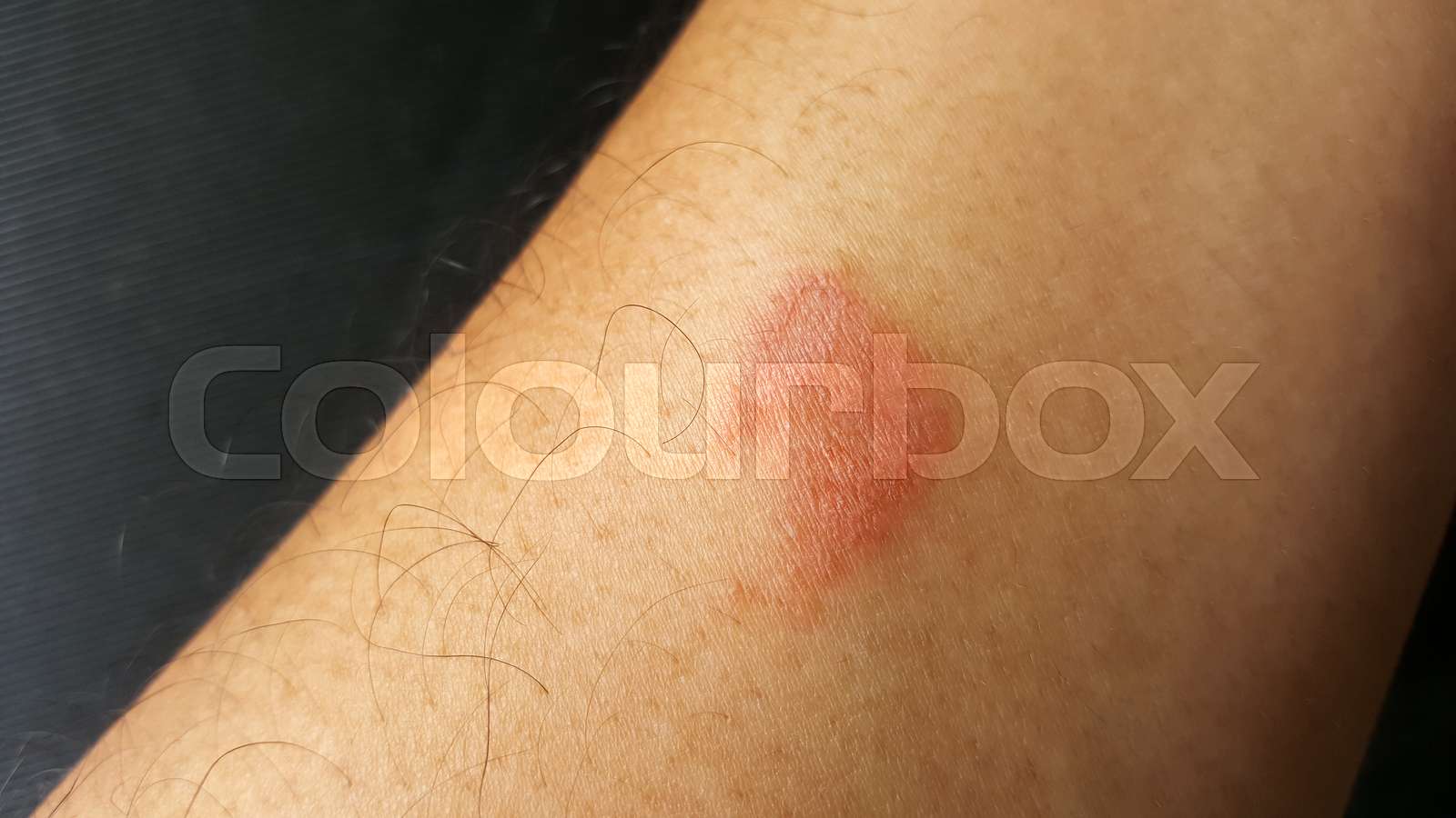 close-up centipede bite, poisonous hurt arm | Stock image | Colourbox