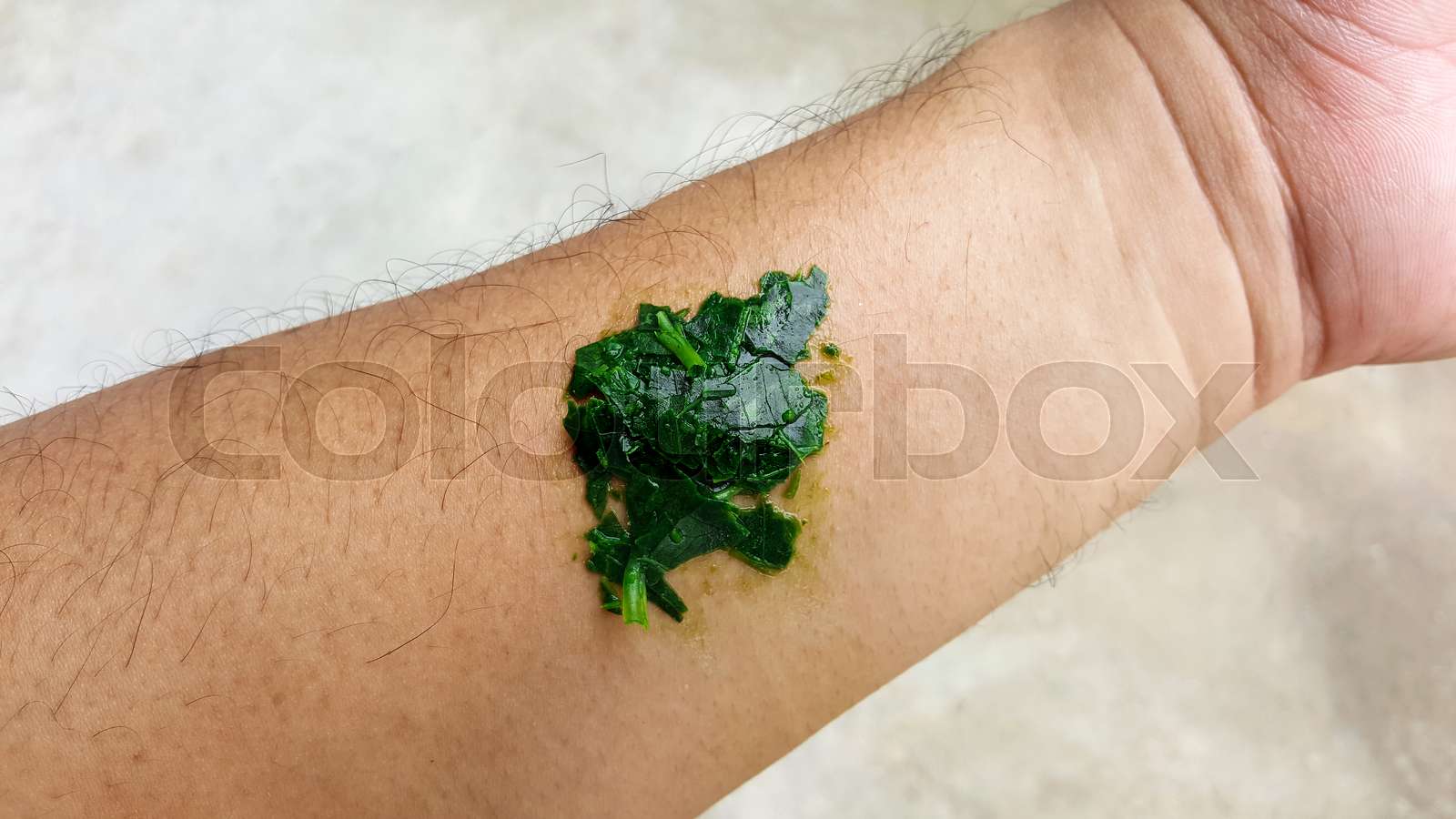 close-up centipede bite, poisonous hurt arm cure with herbal medicine ...