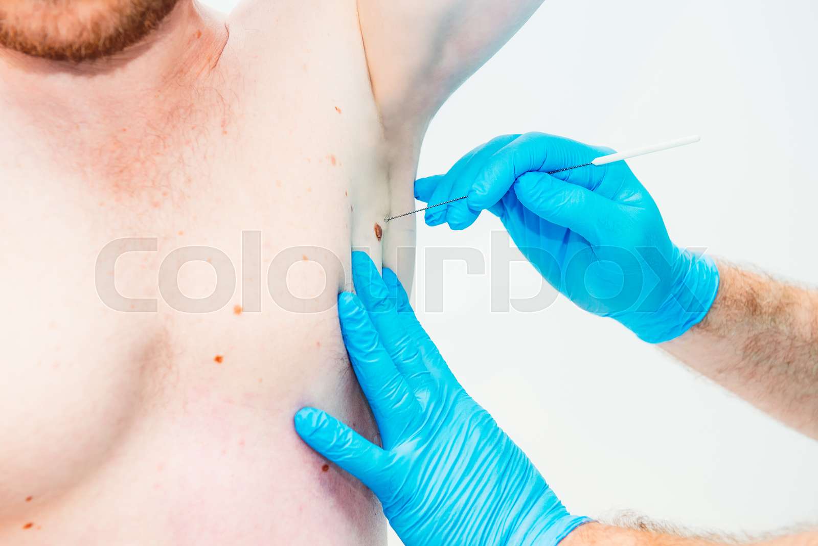 Close Up Doctor Dermatologist Hands In Gloves Examines Underarm