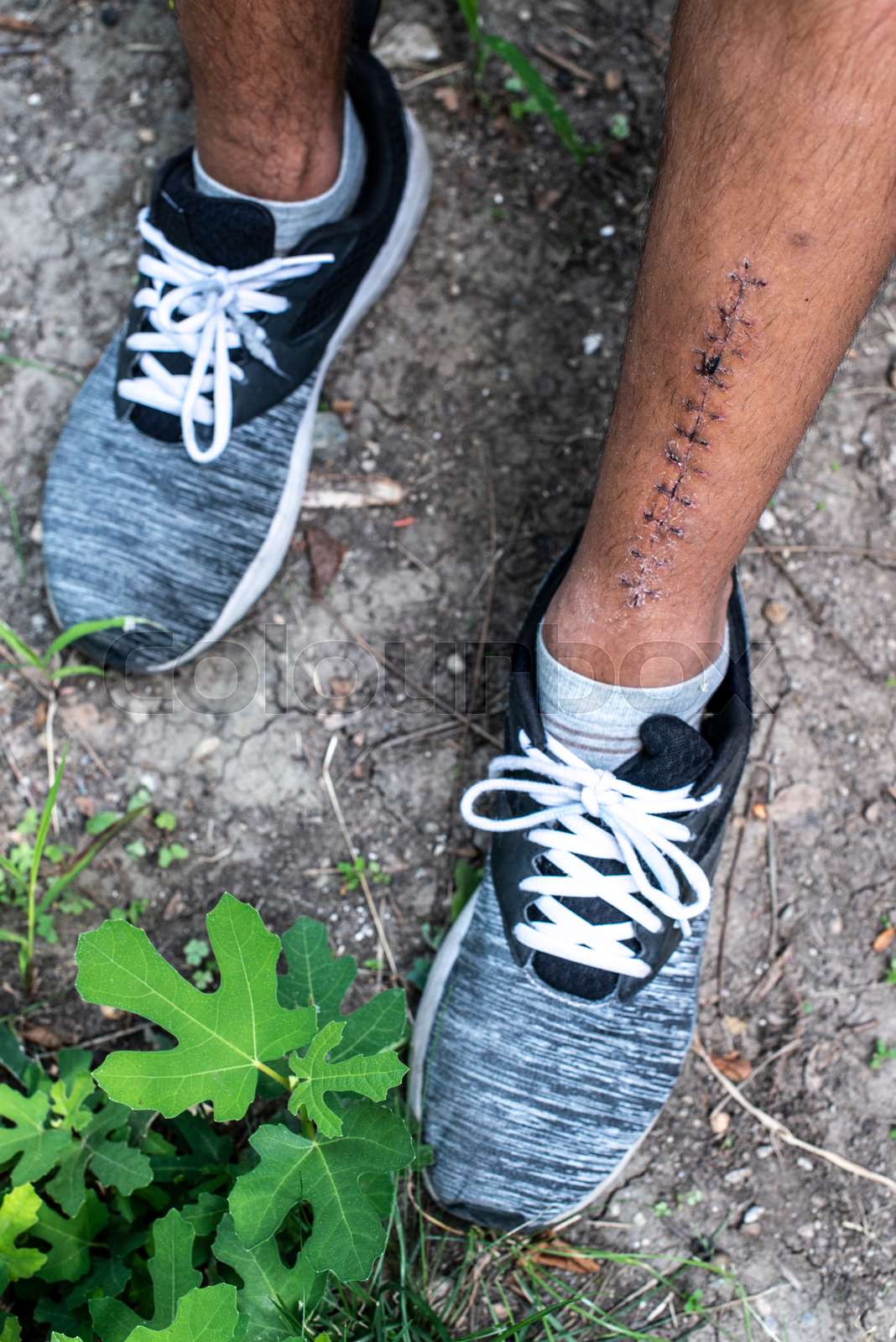 Stitch leg injury | Stock image | Colourbox