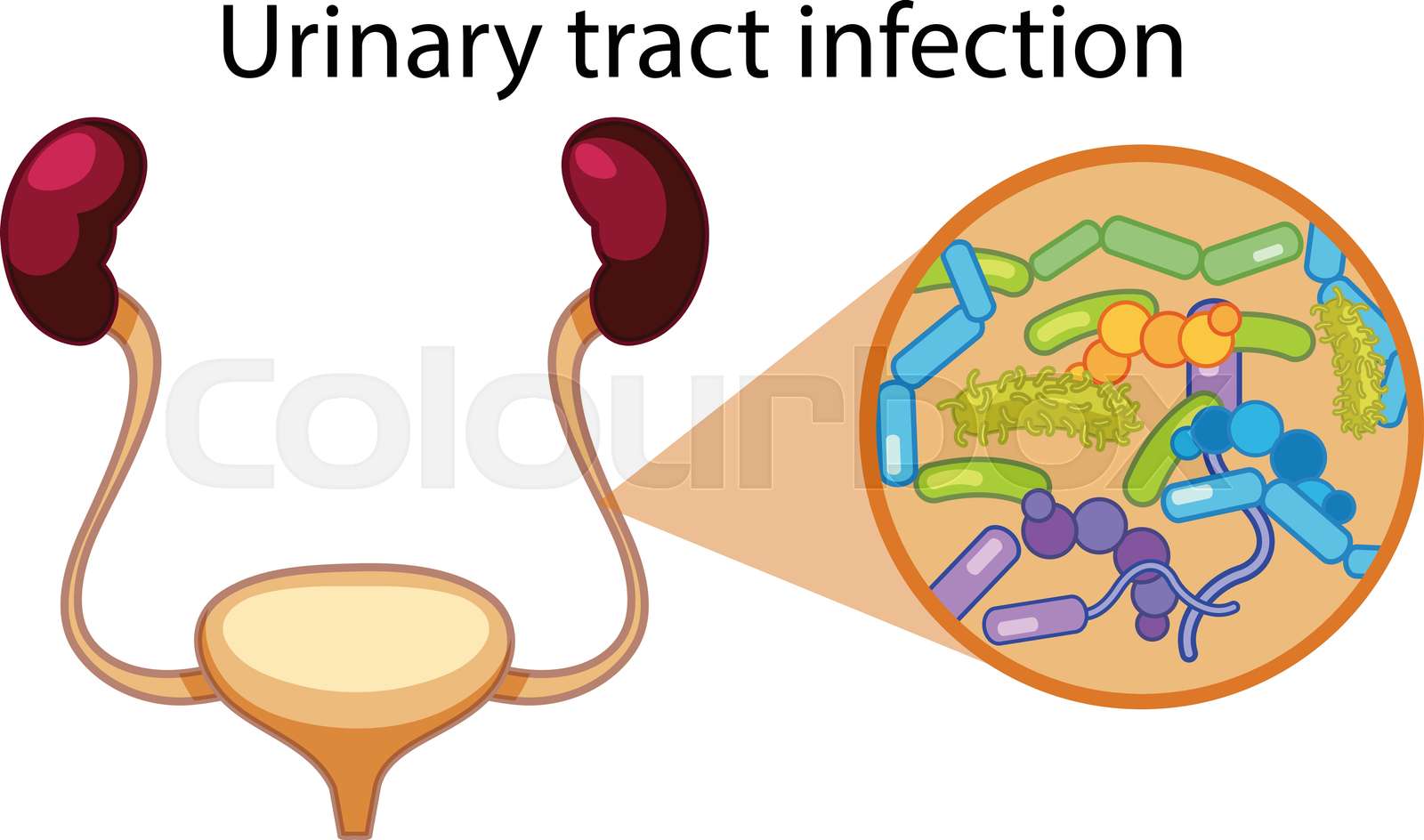 Human Urinary Tract Infection | Stock vector | Colourbox