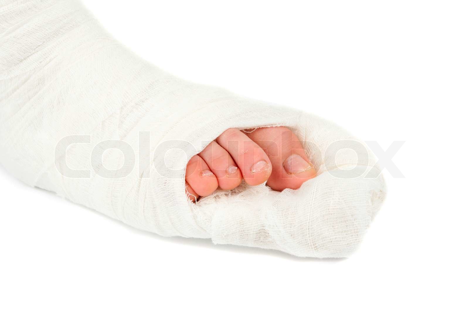 leg in a plaster cast | Stock image | Colourbox
