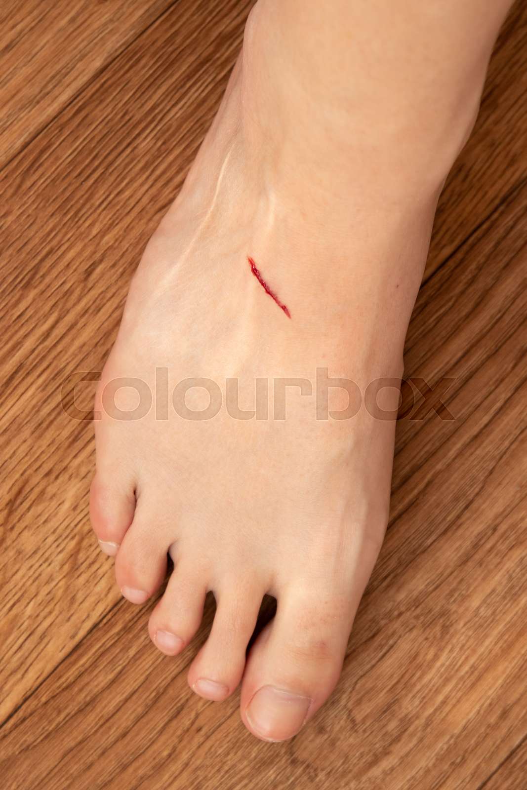 Incision on the leg | Stock image | Colourbox