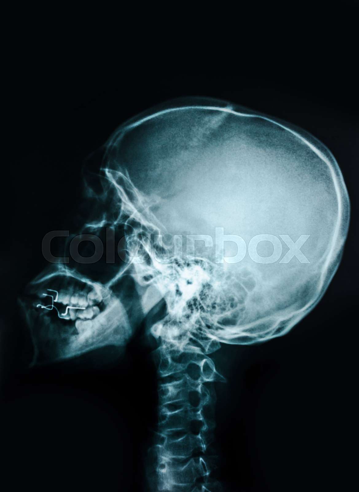 Film x-ray skull. | Stock image | Colourbox