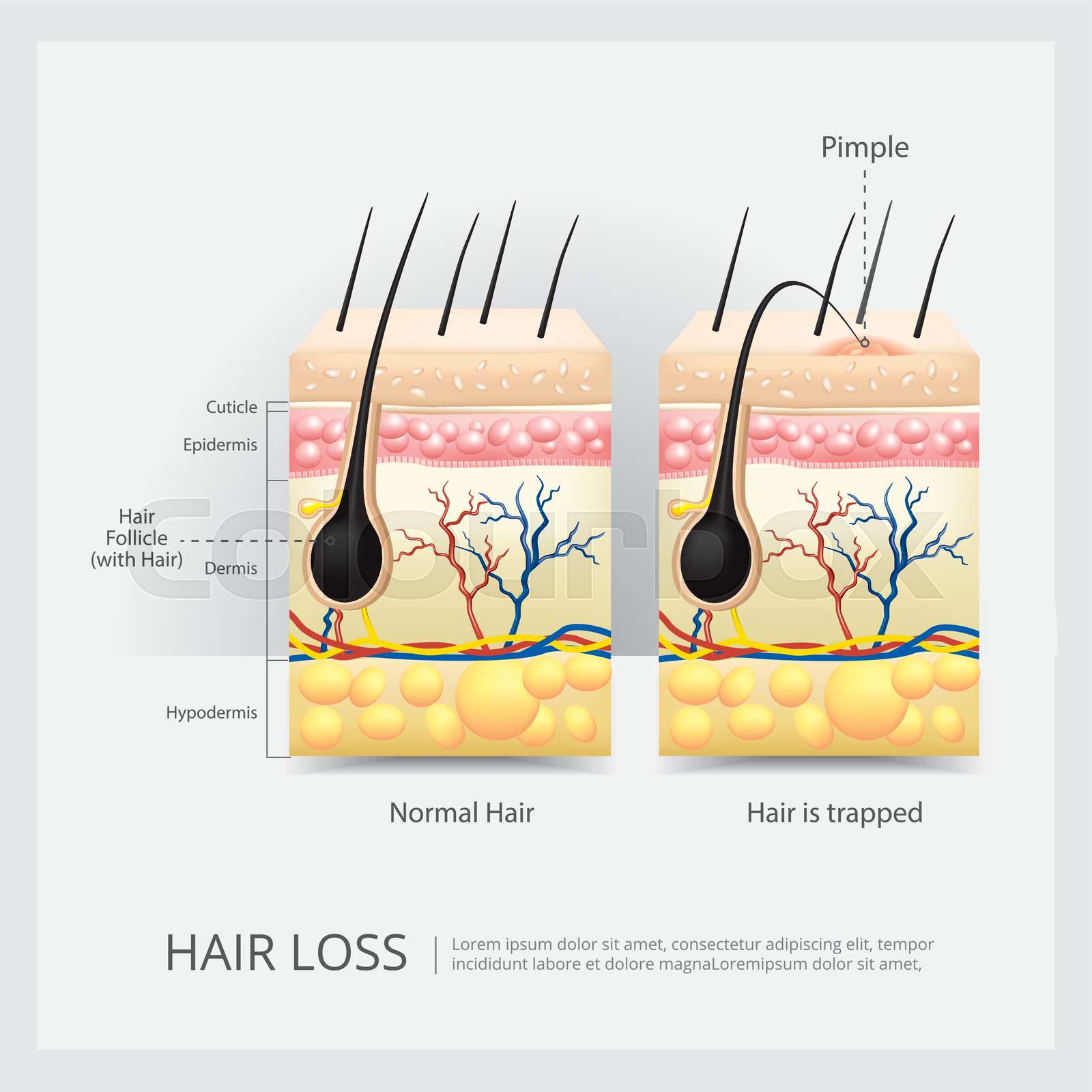 Ingrown Hair Structure Vector Illustration Stock Vector Colourbox