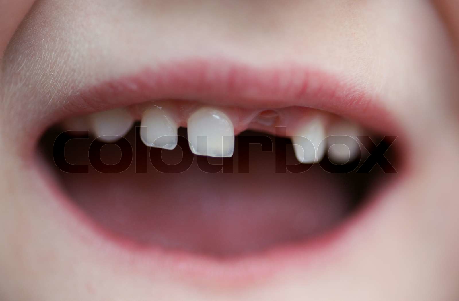 Barn har tabt en tand | Stock foto | Colourbox