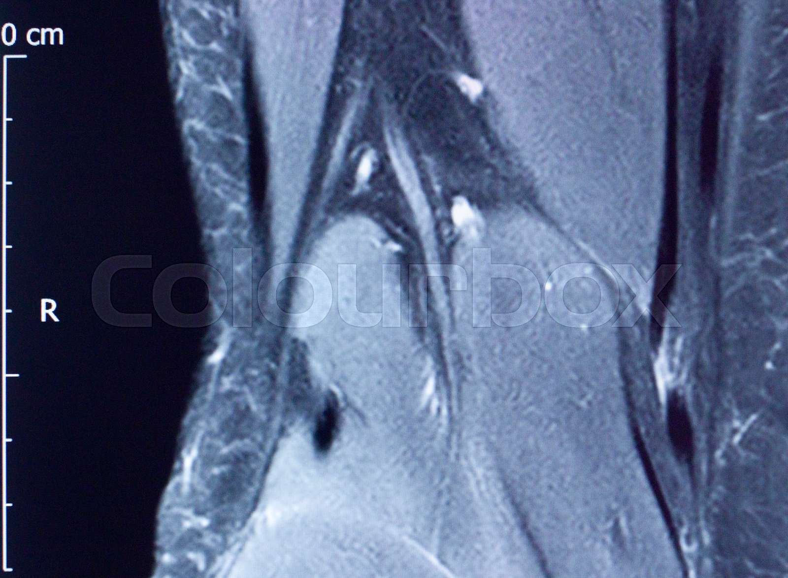 Knee injury mri mcl tear | Stock image | Colourbox