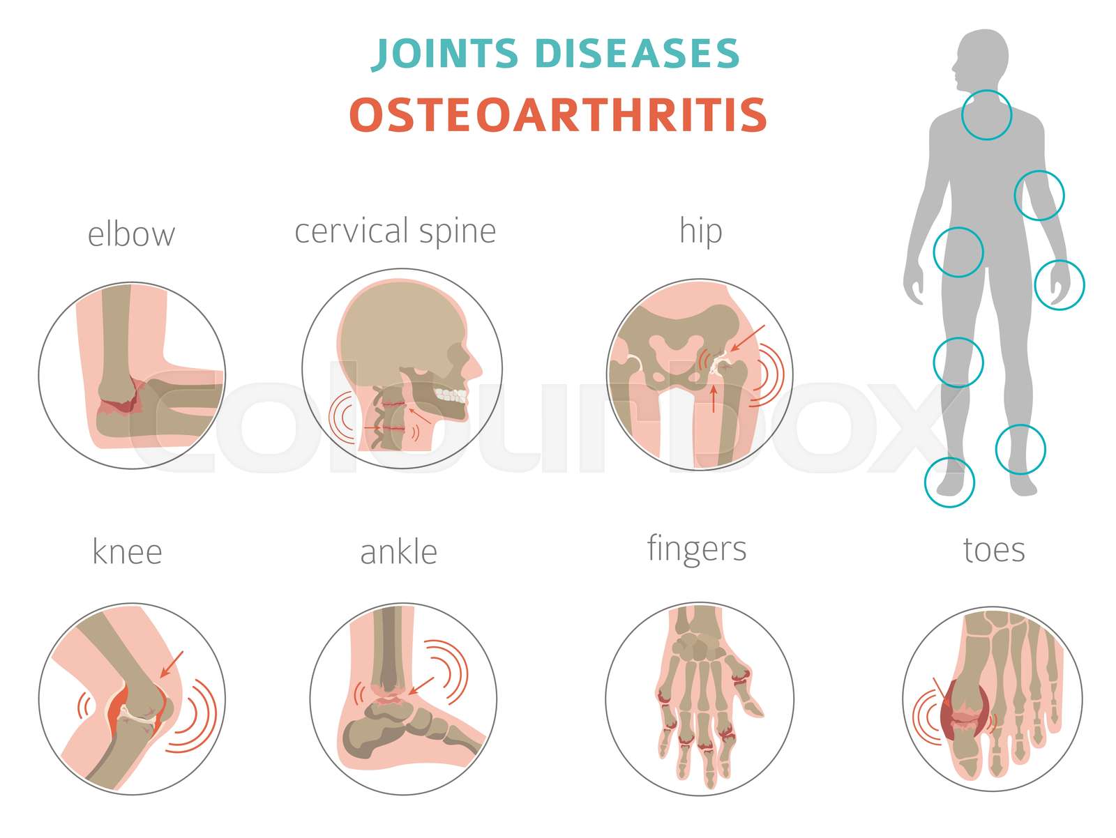 Arthritis, osteoarthritis medical infographic design. Joint replacement ...