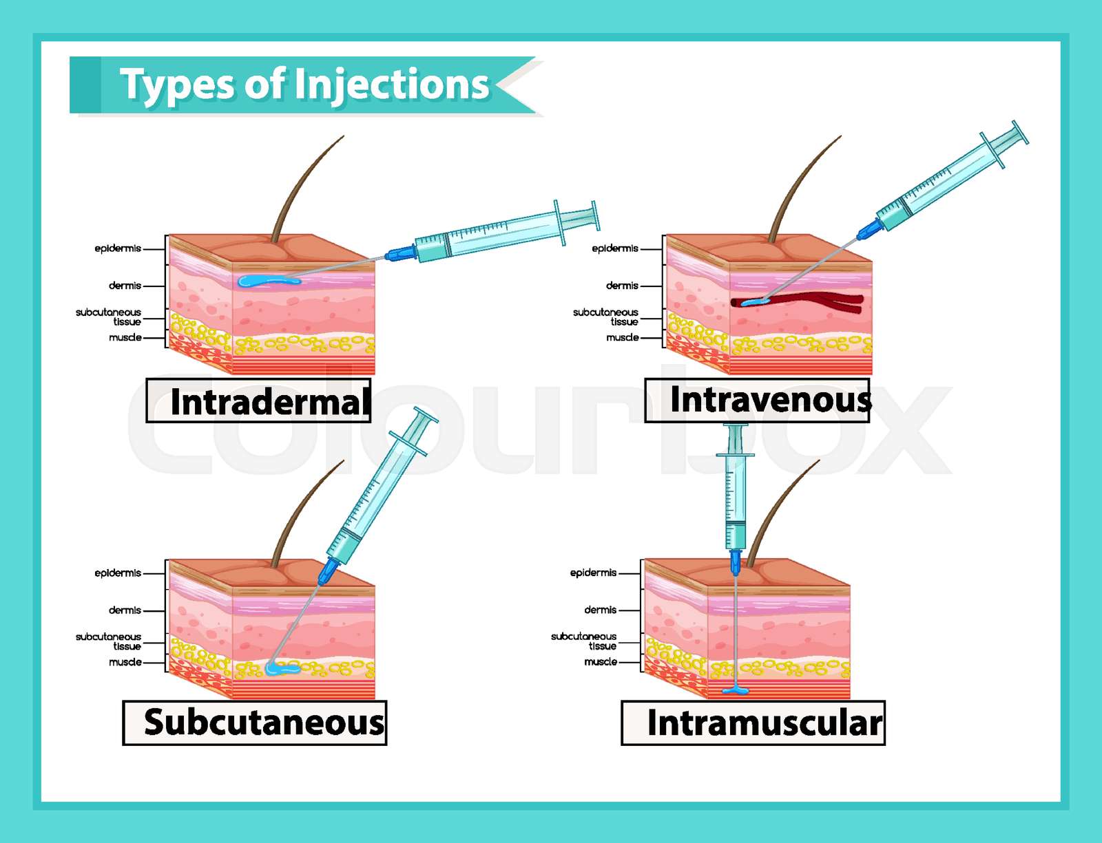 Scientific medical illustration of types of injections | Stock vector ...