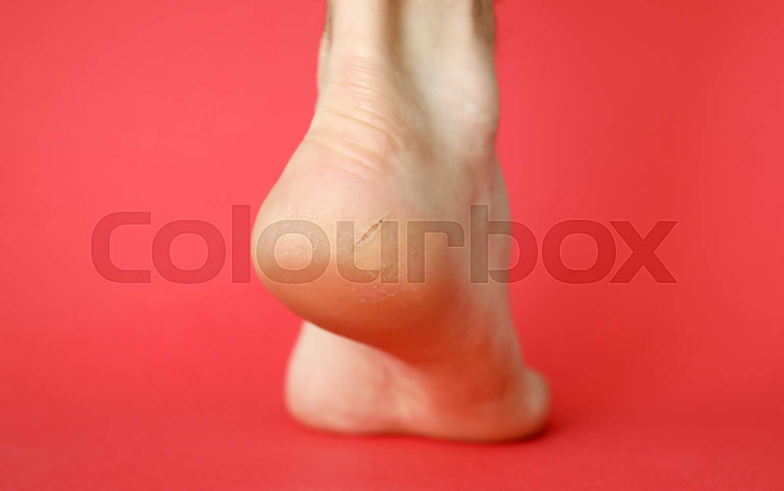 Heel with a cracked skin disease on a red | Stock image | Colourbox