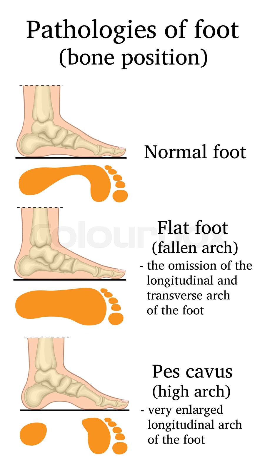 Foot pathology illustration | Stock vector | Colourbox