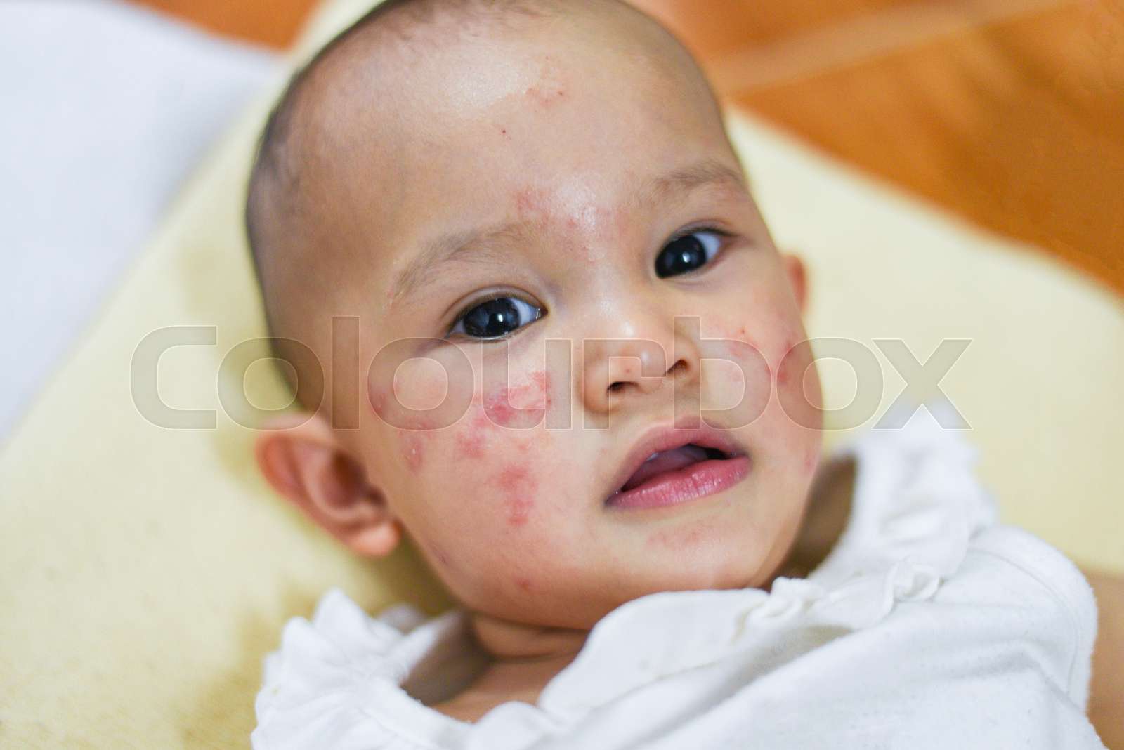 Rash baby allergy on face / disease baby girl face dry skin itching and ...