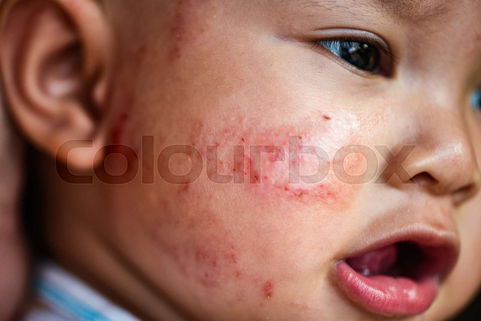 rash baby allergy on face / disease baby girl face dry skin itching and ...