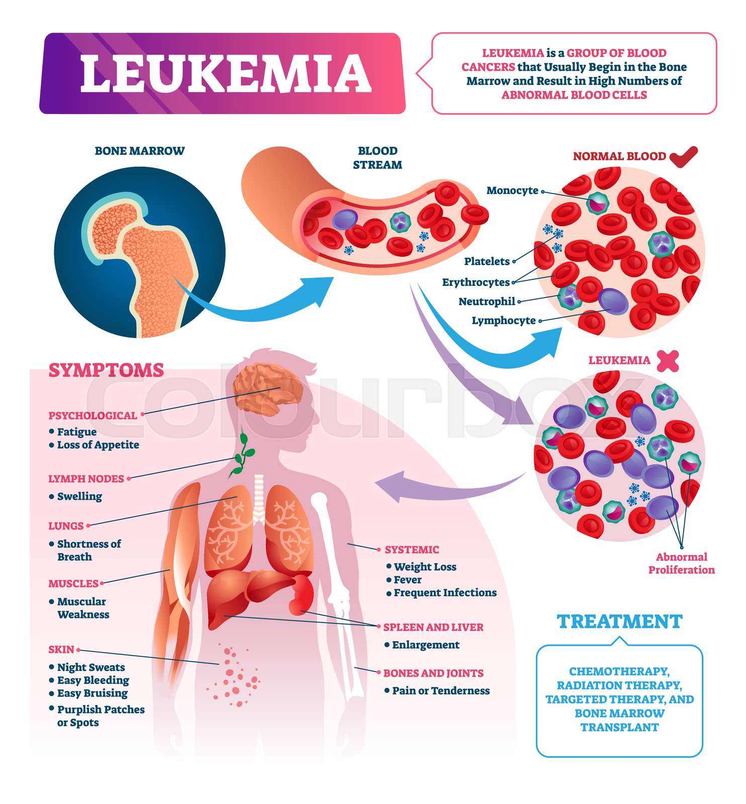 Leukemia vector illustration. Labeled educational blood cancer ...