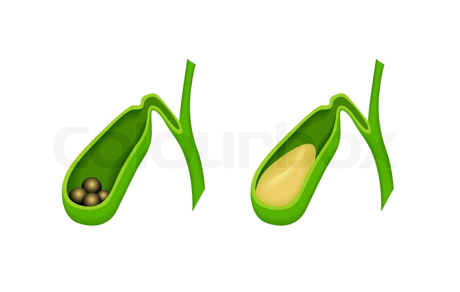 Gallstones | Stock vector | Colourbox