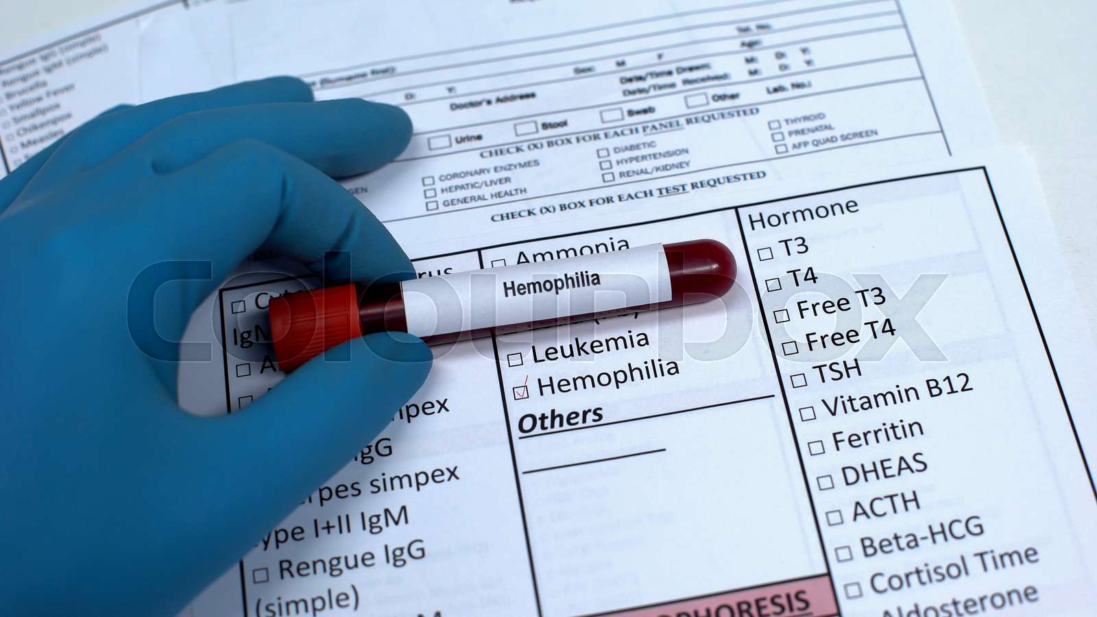 Positive Hemophilia test, doctor showing blood sample in tube, health ...