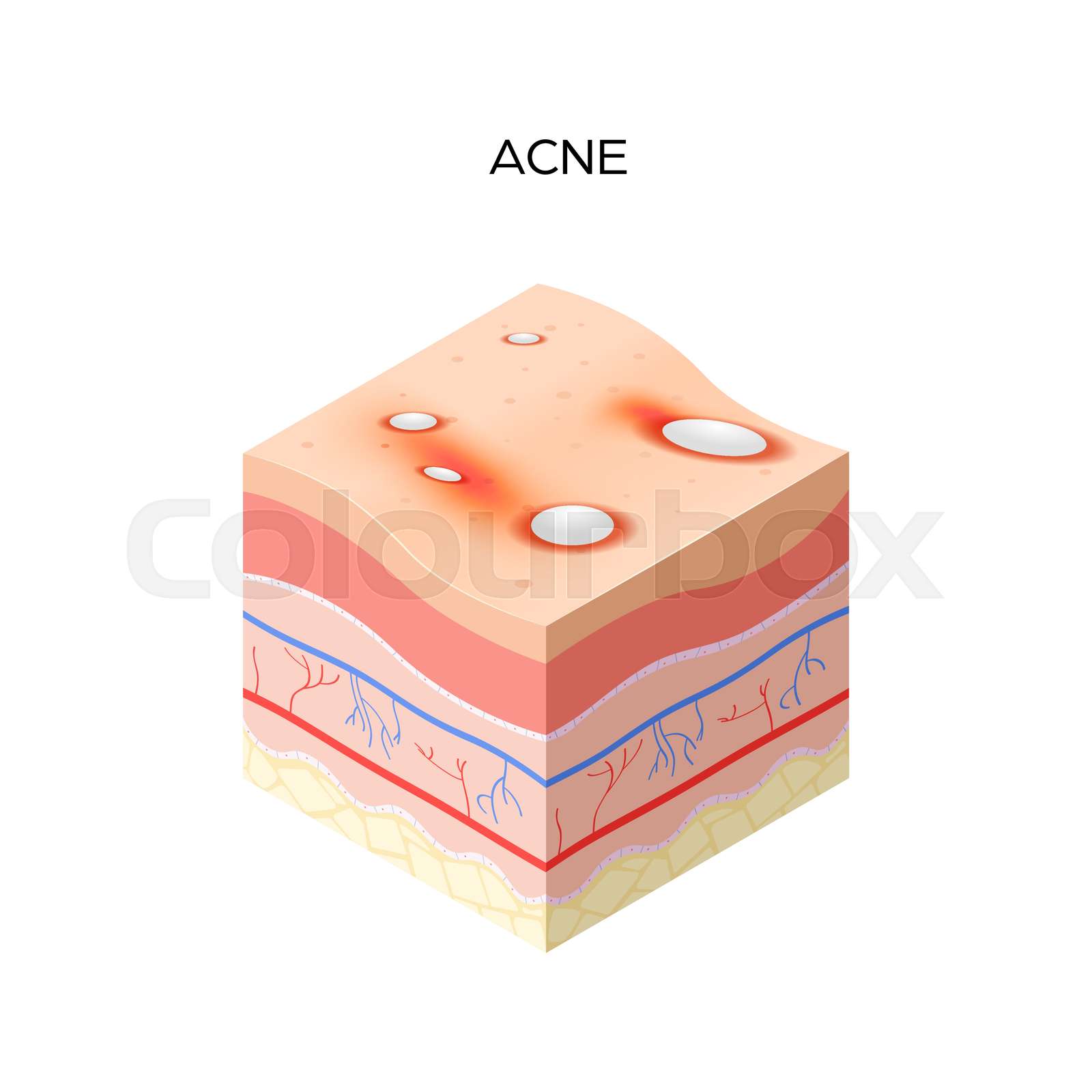 Acne vulgaris or pimple cross-section of human skin layers structure ...