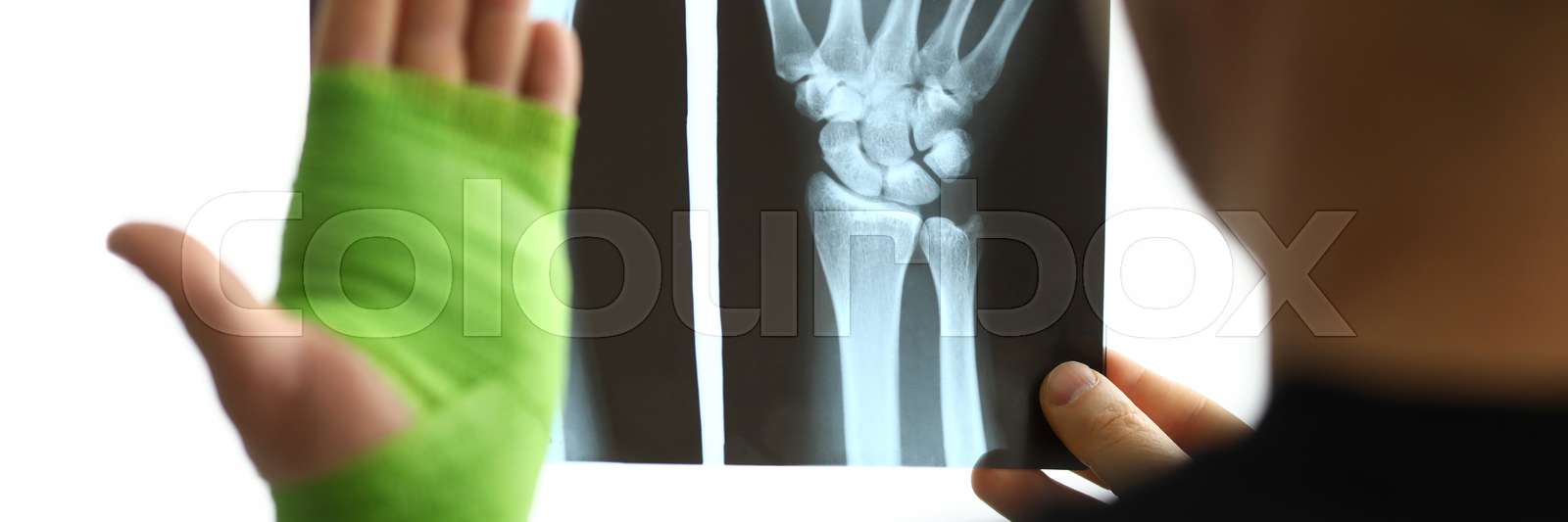 Male patient hold in hand CT scan of his broken arm at doctor ...