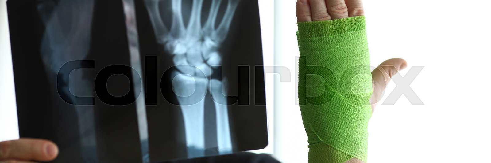 Male patient hold in hand CT scan of his broken arm at doctor ...