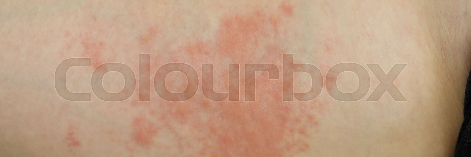 Allergic rush on skin | Stock image | Colourbox