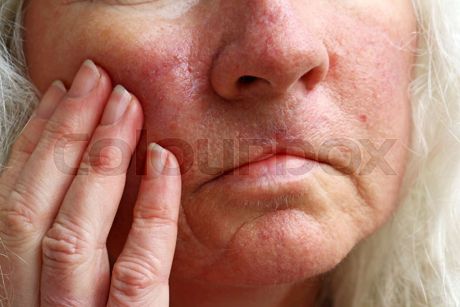 Rote Äderchen, Flecken und Operations-Narben im Gesicht einer älteren ...