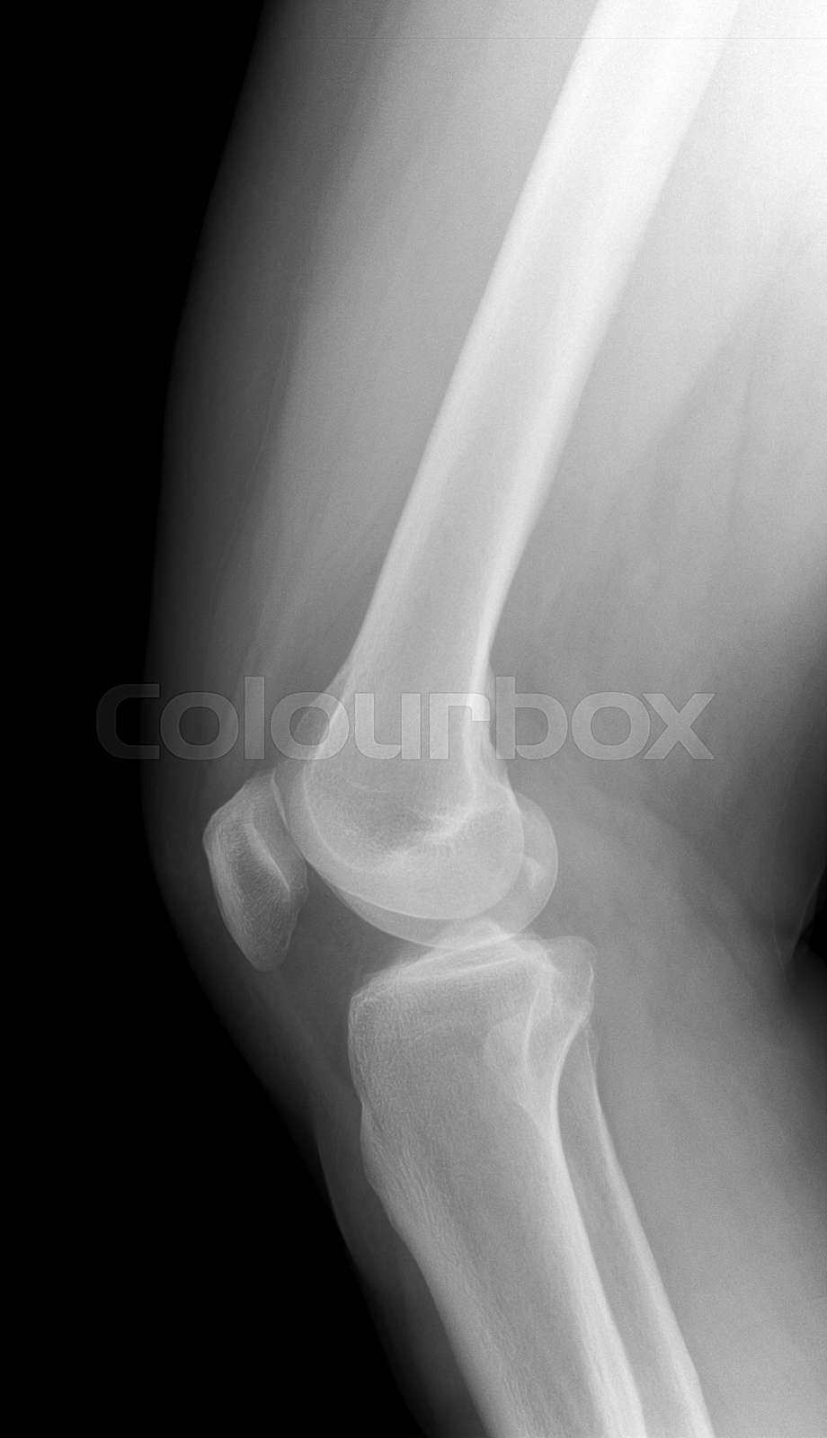 Image Of Knee X-Ray. Detecting Radiographic Knee Osteoarthritis ...