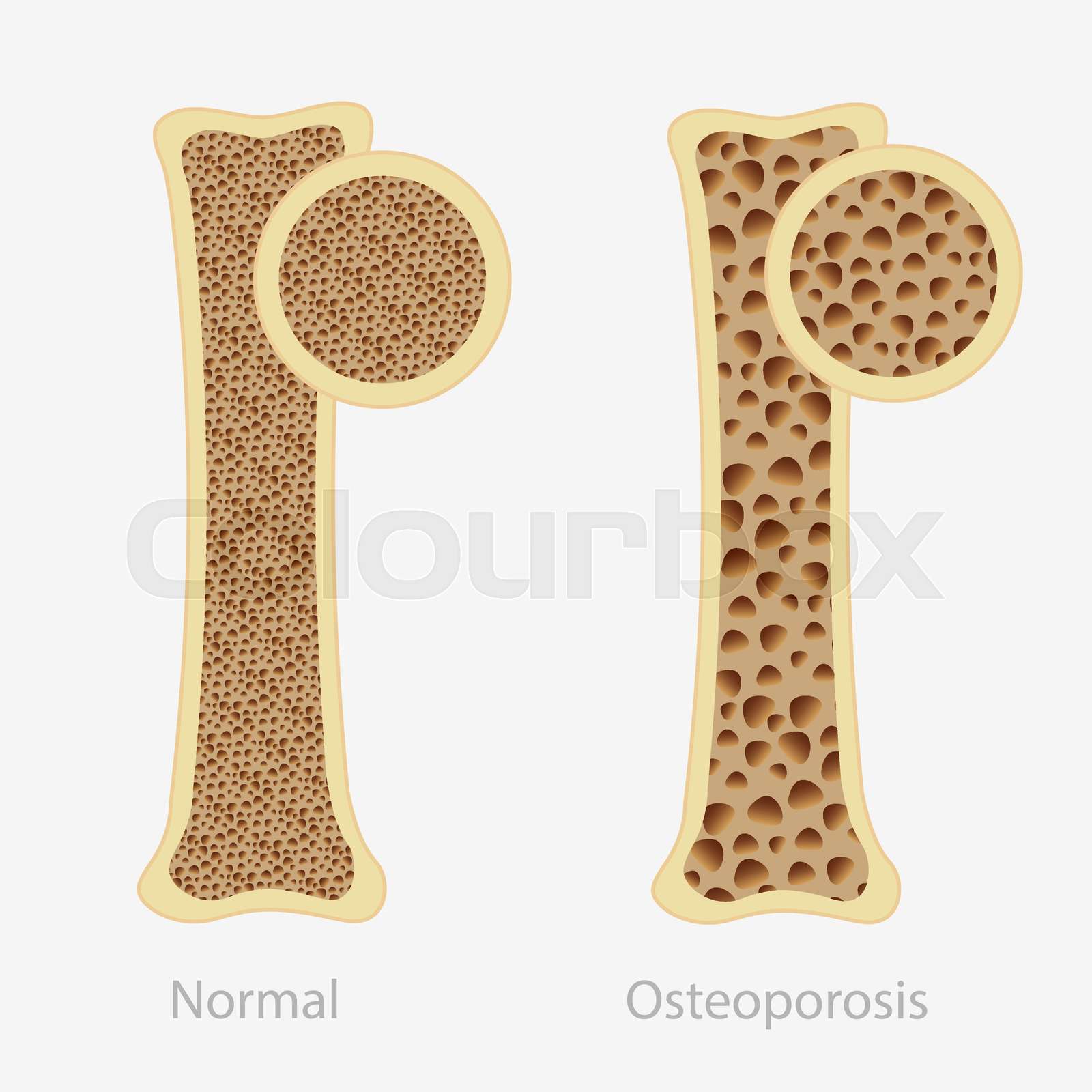 Cartoon human osteoporosis and normal healthy bone vector flat ...