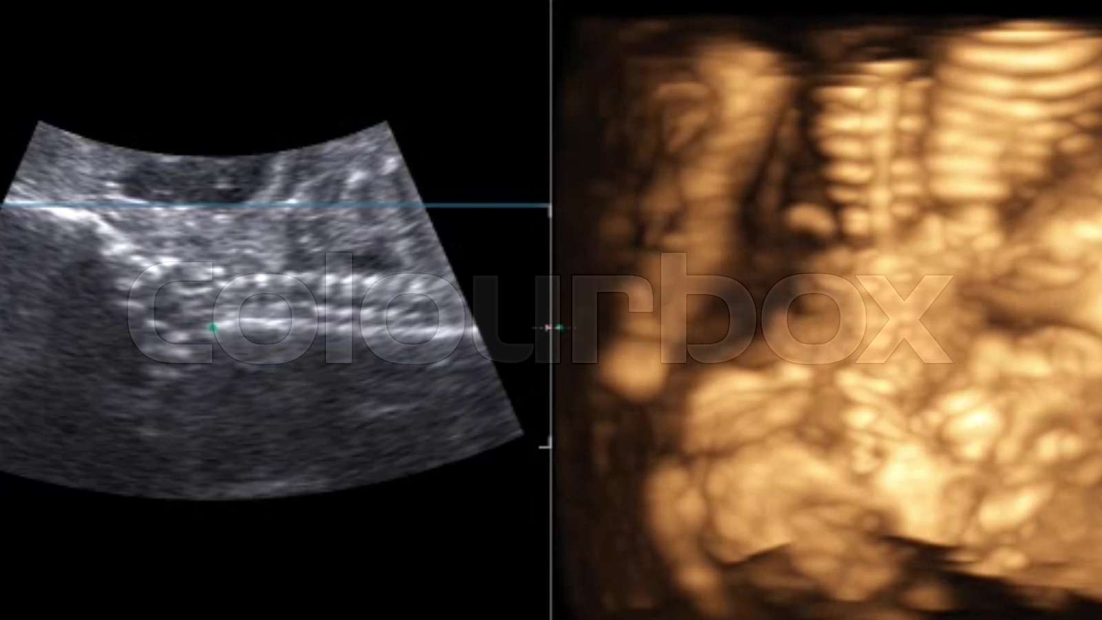 Motion of 4D Ultrasound Echography of baby un mother's womb. Life ...